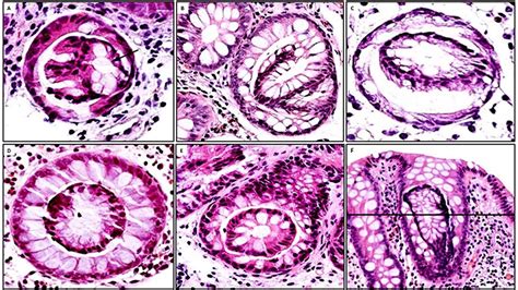 Novel Histological Repertoire Of Crypt Associated Anomalies In Inflamed