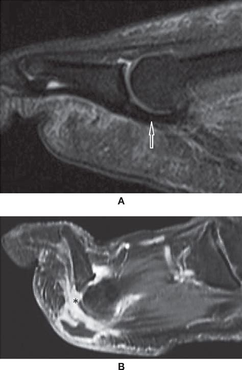 25 Magnetic Resonance Imaging Of Foot And Ankle Pathology