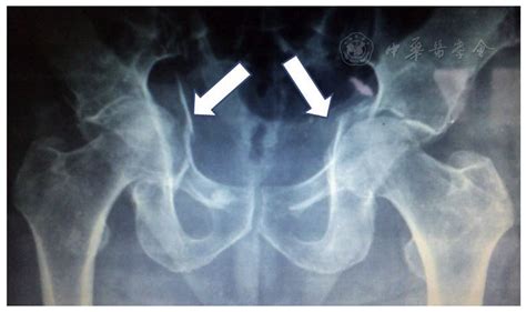 Simultaneous Bilateral Shoulder And Bilateral Central Acetabular Fracture Dislocation What To