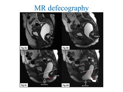 Pediatric Constipation Ppt