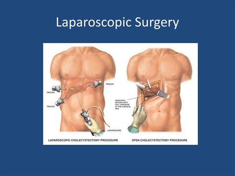Ppt Laparoscopic Surgery Powerpoint Presentation Free Download Id