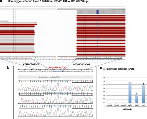 Parkin Exon 5 Deletion 128 Kb A Wgs Reads Were Visualized By Using