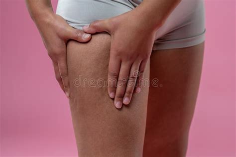 Close Up Of Woman Checking Her Legs On Cellulitis Stock Image Image