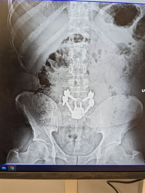 6 Weeks Post L5 S1 Fusion Cleared To Jog Fat Bike And Ski Im Stoked Check Out The Hardware