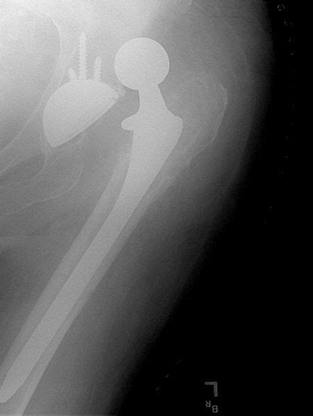Hip Dislocation Physiopedia