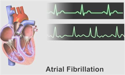 Iv Sotalol Loading Safe And Feasible In Adult Patients With Atrial