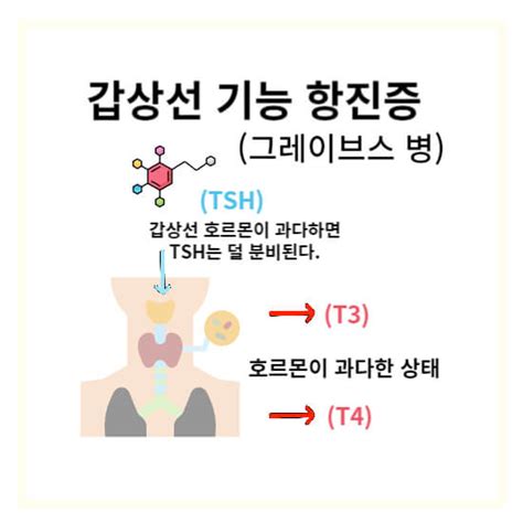 갑상선 기능 항진증 쉽게 설명 원인 증상 합병증