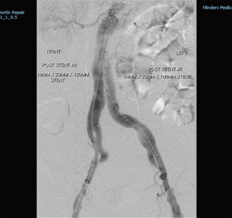 Case Report Managing An Infrarenal Aaa With Significant Iliac