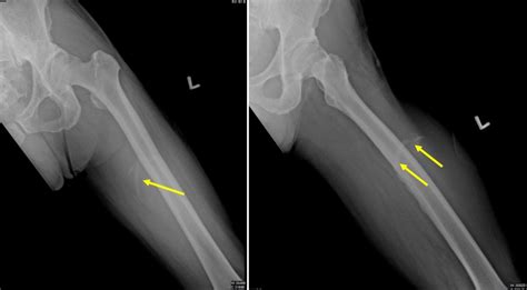 Extraskeletal Osteosarcoma Radiology Cases