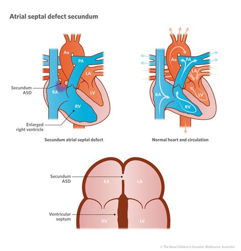 Cardiology Atrial Septal Defect Asd