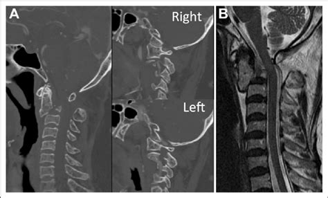 A Sagittal Ct Scan Of The Cervical Spine Showing A Hangmans Download Scientific Diagram