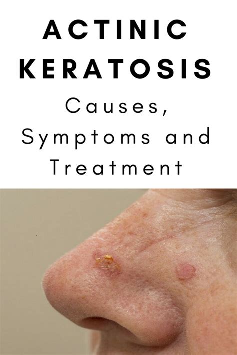 Actinic Keratosis Treatment