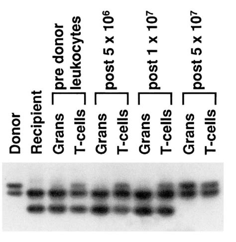 Graft Vs Leukemia Effect Semantic Scholar