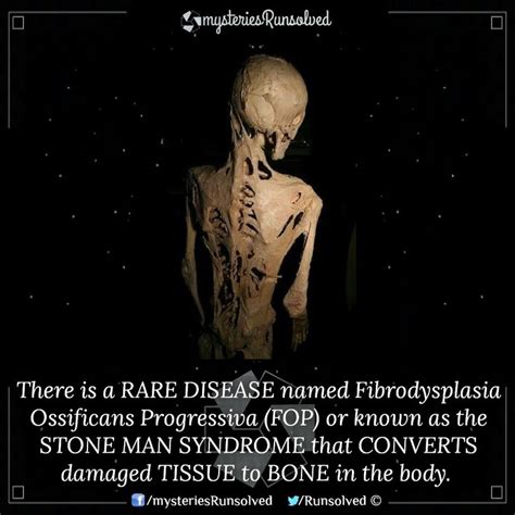 10 Of The Strangest Rare Diseases You Wont Believe Are Real