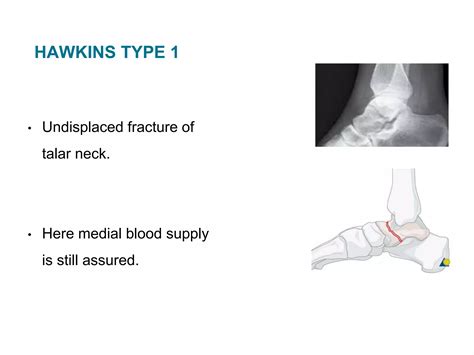 Talus Fracture Treatment Algorithm Ppt