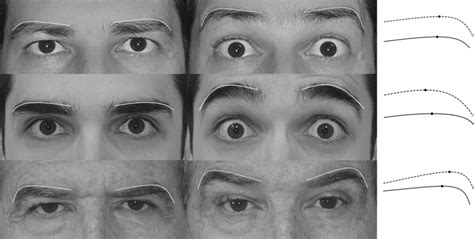 Patterns Of Brow Elevation The Bezier Lines Show The Difference In The