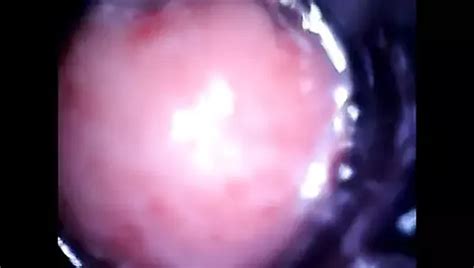 Free Endoscope Porn Videos Xhamster