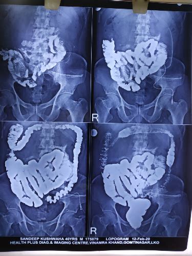 X Ray Loopogram Loopogram X Ray Artofit