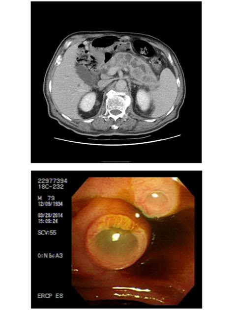 Intraductal Papillary Mucinous Neoplasm Ipmn Of Pancreas In Elderly