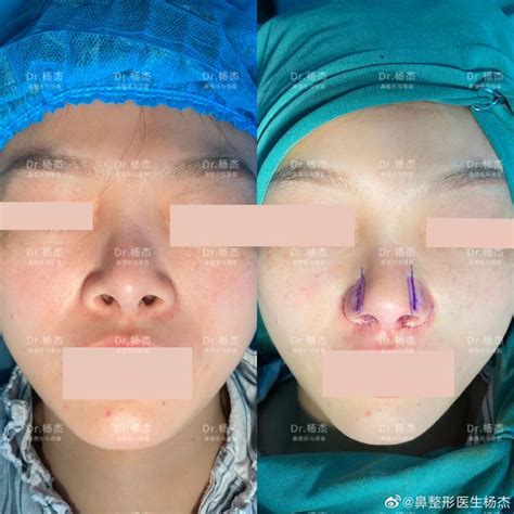 我的鼻翼缘退缩修复方法及微创理念 知乎
