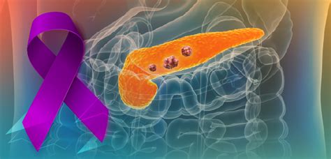 Neoadjuvant Therapy Nccn Recommendations Take The Melanoma Field In A New Direction Onclive