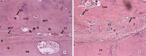 Histometric Analyses Of Cancellous And Cortical Interface In Autogenous Bone Grafting Pmc
