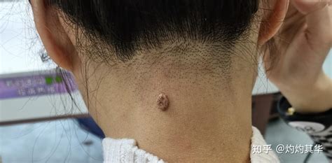 手术切除颈后痣经历 知乎