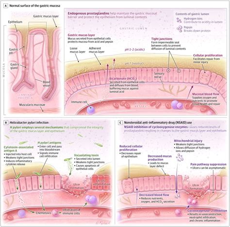 Peptic Ulcer Disease Ama Ed Hub