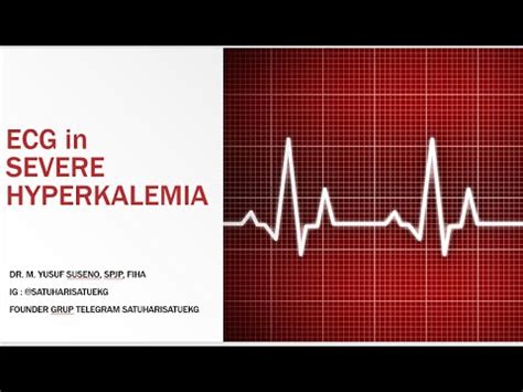 EKG Pada Pasien Dengan Hiperkalemia Berat YouTube