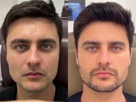 OFF Harmonização facial em homens Veja o antes e depois de 10 famosos