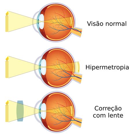 Anomalias da visão Óptica Física InfoEscola