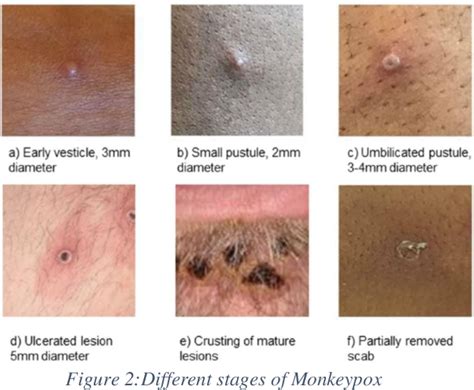 Figure 2 From A Comparative Analysis Of Cnn Based Pretrained Models For The Detection And