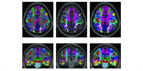 Comparison Of Cortex Parcellation With The Destrieux Atlas Gray Download Scientific Diagram