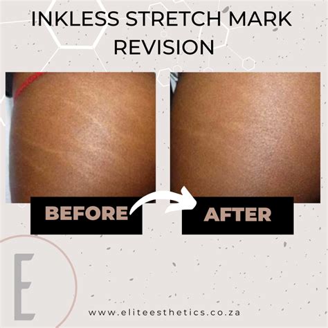 Inkless Stretch Mark Scar Revision Elite Esthetics Beauty Training Academy