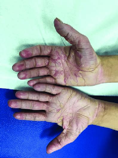 Bilateral Thickened Palmar Keratoderma With Mild Peripheral Erythema On Download Scientific