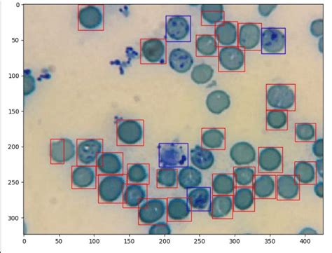 Reticulocyte Supravital Stain