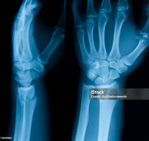 Gambar Sinarx Memperlihatkan Fraktur Radius Distal Foto Stok Unduh