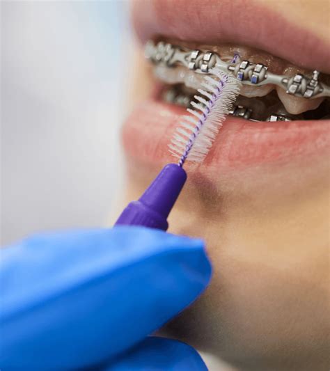 Interdental Brushing In Leeds Interdental Brushing Dentists
