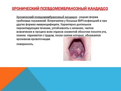 Кандидоз полости рта у детей Online Presentation