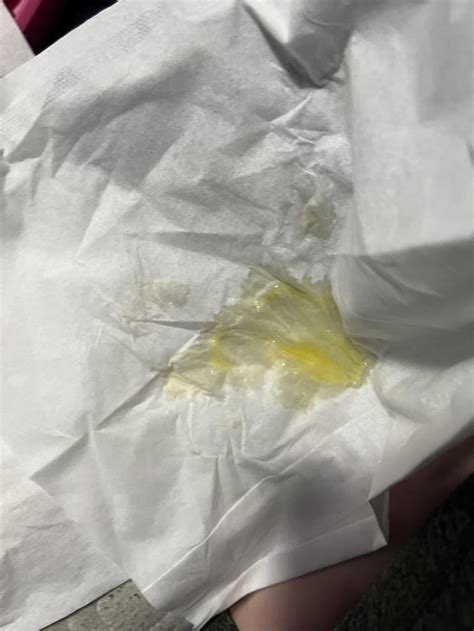 In The Last Ten Minutes My Snot Has Turned Neon Yellow Rmedicaladvice