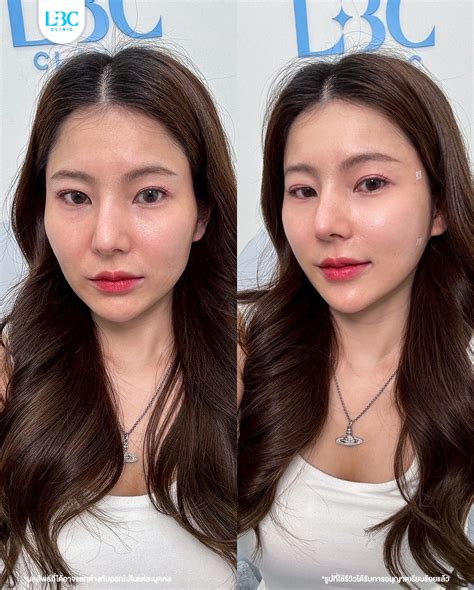 Lbc Clinic แอลบีซี คลินิก โปรแกรมเติมเต็ม 6 ซีซีราคาเดียว 11 990 จะฉีด Neuramis ทั้ง 6 ซีซี