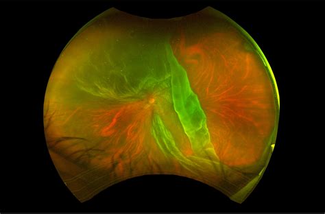 Surgical Retina Surgery For Retinal Detachment