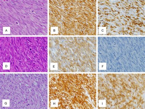 Gastrointestinal Stromal Tumors With Exon 8 C Kit Gene Mutation Might