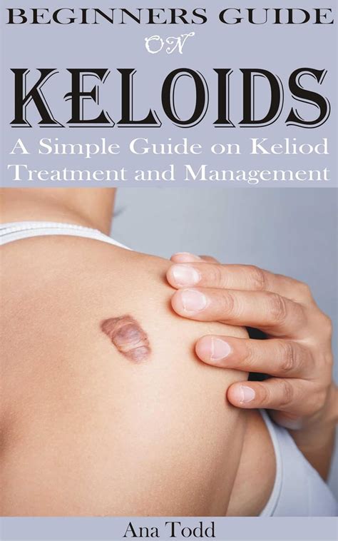 Beginners Guide On Keloids A Simple Guide On Keloid Treatment And