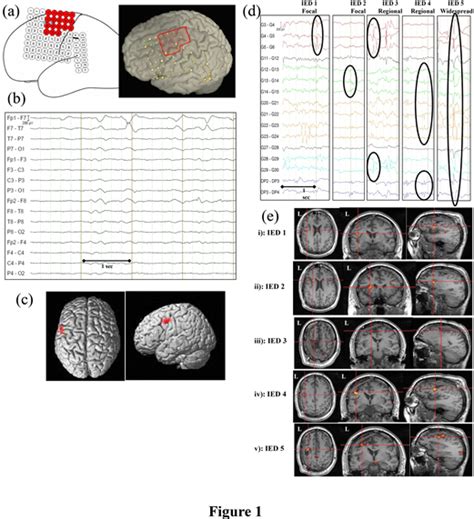 Epileptic Networks Using Scalp And Intracranial Eeg Fmri And