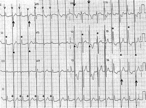 Ecg Challenge New Beats With A Pacemaker