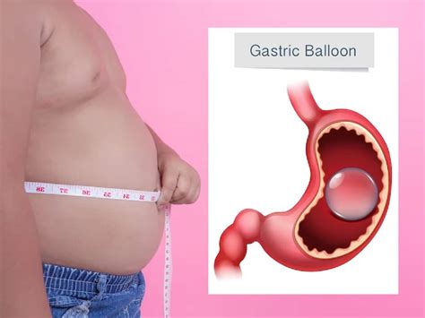 Gastric Balloon For Weight Loss Benefits Procedure And Side Effects