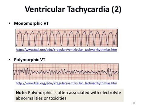 Monomorphic Vs Polymorphic Ventricular Tachycardia Strip Monomorphic Vs Polymorphic Ventricular Tachycardia Strip