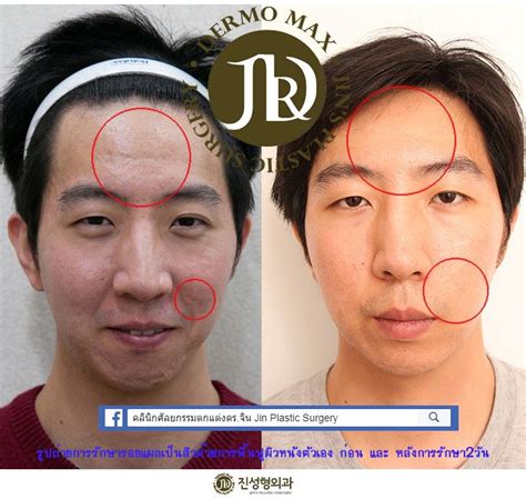 การรักษาร คลินิกศัลยกรรมตกแต่งดร จิน Jin Plastic Surgery Facebook
