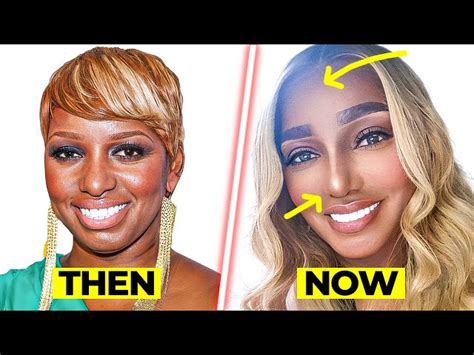 Nene Leakes Plastic Surgery Before And After Photos